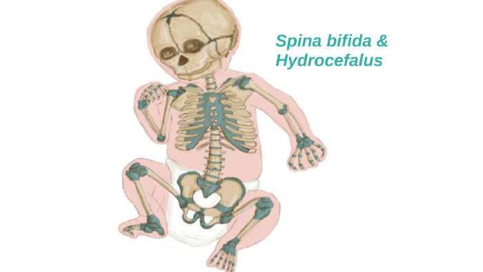 Spina bifida & Hydrocefalus by Anne Cornelisse on Prezi