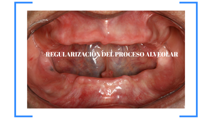 REGULARIZACIÓN DEL PROCESO ALVEOLAR by David Llanes on Prezi