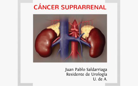 Cancer Suprarrenal by juan saldarriaga on Prezi