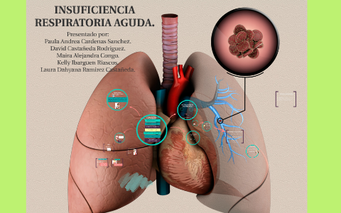 INSUFICIENCIA RESPIRATORIA AGUDA. by José David Montaña García on Prezi