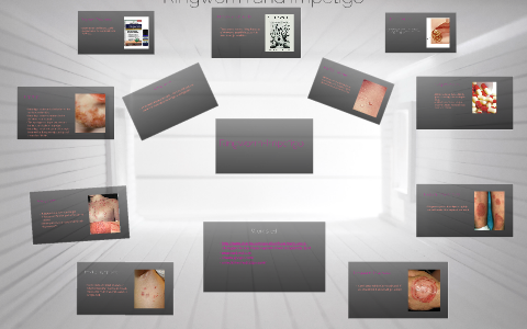 Impetigo- Ringworm by Jessica James on Prezi