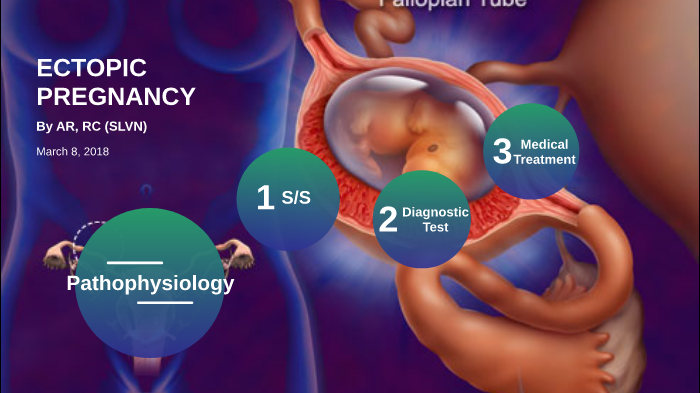 Ectopic Pregnancy Project By Ariana Rodriguez On Prezi