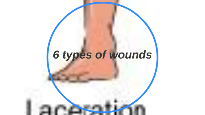 6 types of wounds by lloyd pinheiro on Prezi