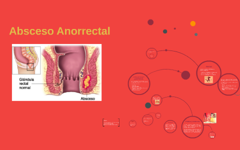 Absceso Anorrectal by Jenniiy Hdez Aguirre on Prezi