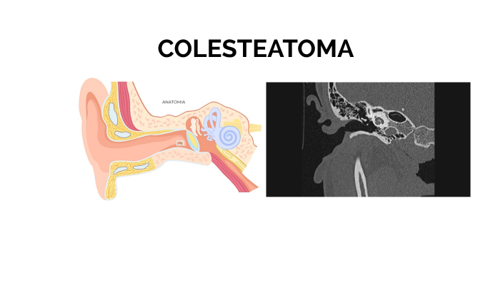 COLESTEATOMA by MIGUEL E. ROCHA on Prezi