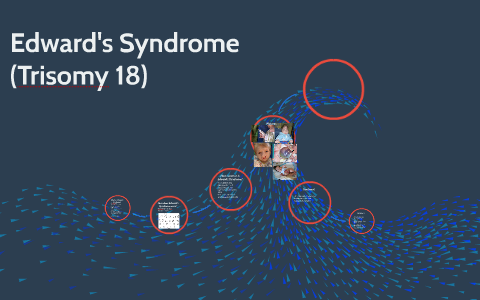 Edward's Syndrome (Trisomy 18) by Jacob Seitz on Prezi