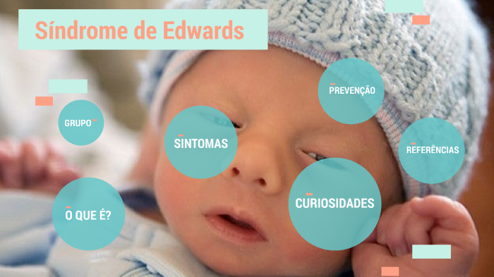 Sindrome de Edwards by Fernanda Viana Falkoski on Prezi