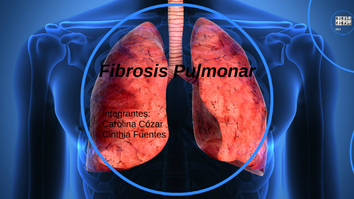 Fibrosis Pulmonar by on Prezi