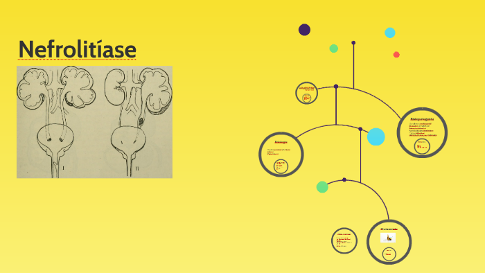 Nefrolitíase by Paulo H on Prezi