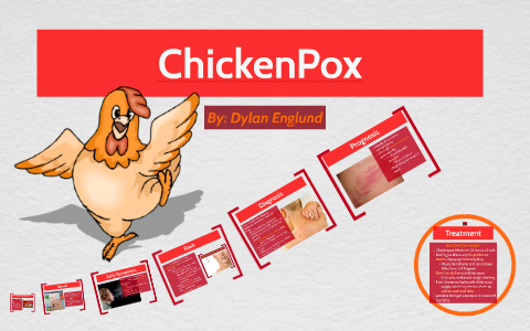 ChickenPox by Dylan Englund on Prezi