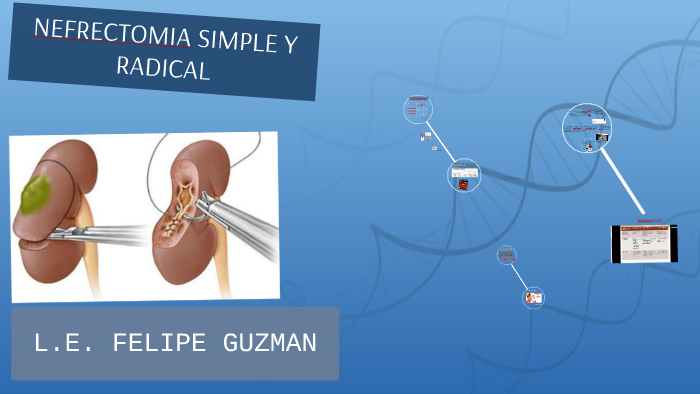 NEFRECTOMIA SIMPLE, RADICAL Y DONADOR PIELOPASTIA by Felipe Guzman on Prezi