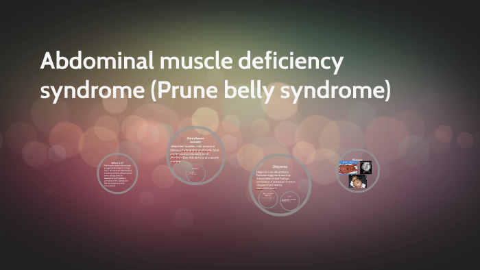 Abdominal muscle deficiency syndrome (Prune belly syndrome) by danielle ...