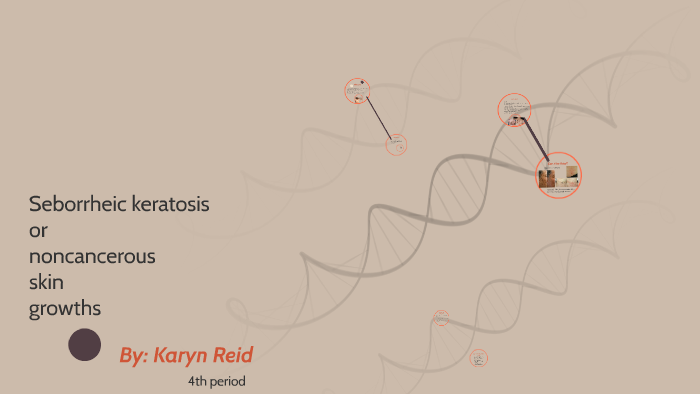 Seborrheic keratosis by karyn reid on Prezi
