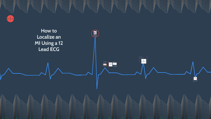 Localization of MI on 12 lead ECG by Kelly Schmalstich on Prezi