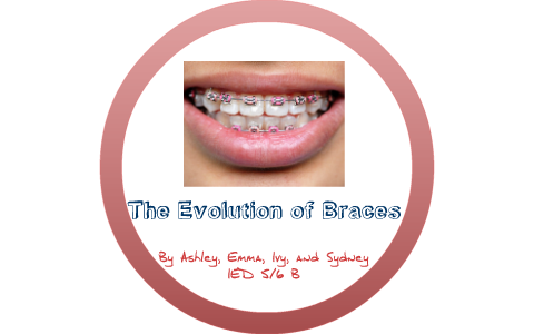 Evolution of Braces by ivy b on Prezi