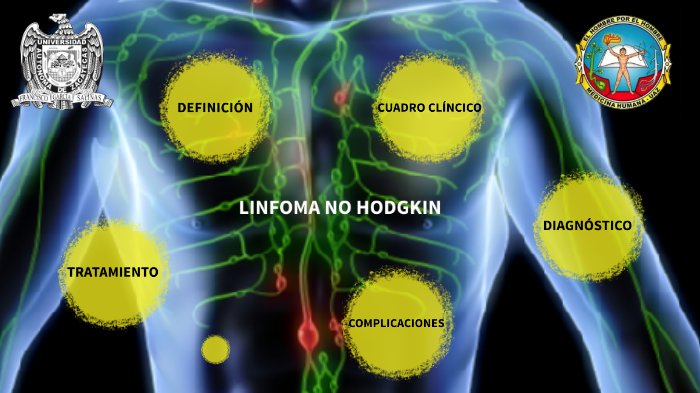 Linfoma No Hodgkin Linfoma No Hodgkin | Linfoma Difuso De Células B
