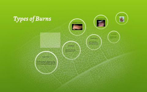 Types of Burns by Matthew Adams on Prezi