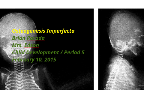 Osteogenesis Imperfecta by Brian Parada on Prezi