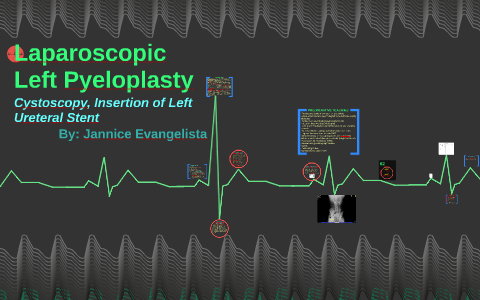 Laparoscopic Left Pyeloplasty by Claire Sogocio on Prezi