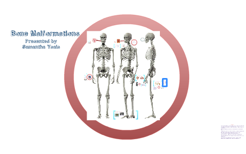 Bone Malformations by Samantha Ysais on Prezi