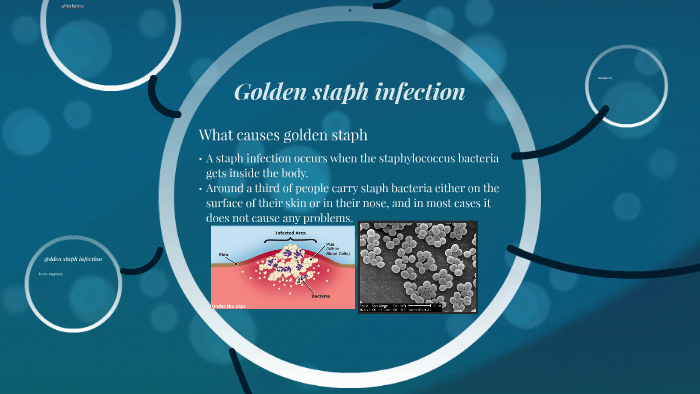 Golden Staph Infection by katelyn eagles on Prezi