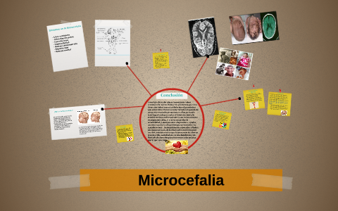 ¿Qué es la microcefalia? by Gaby Dango on Prezi