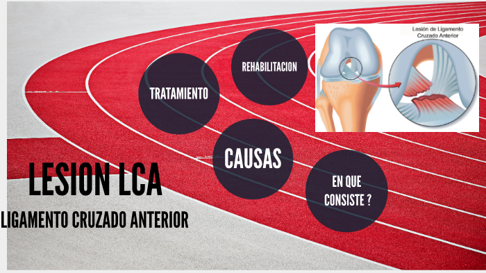 LESION LIGAMENTO CRUZADO ANTERIOR ( LCA ) by camilo cuartas on Prezi