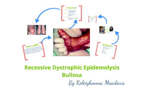 Recessive Dystrophic Epidermolysis Bullosa (RDEB) by Keleighanna ...
