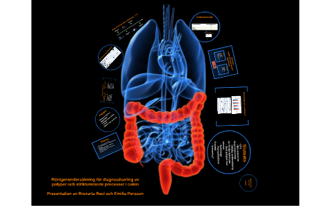 Polyper i colon by Rrezarta Reci on Prezi