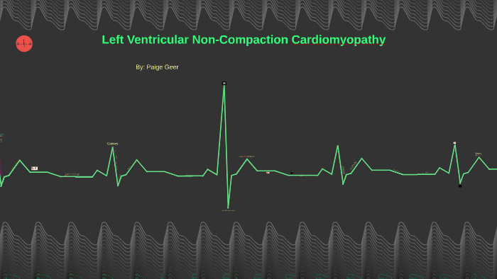 Left Ventricular Non-Compaction Cardiomyopathy (LVNC) by Katlyn Geer on ...