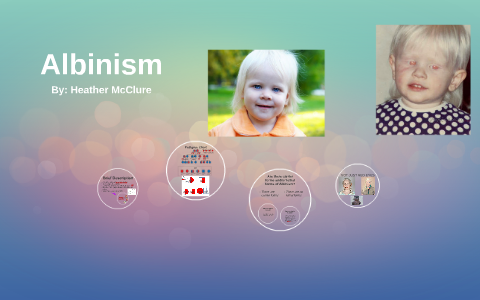 Albinism by on Prezi