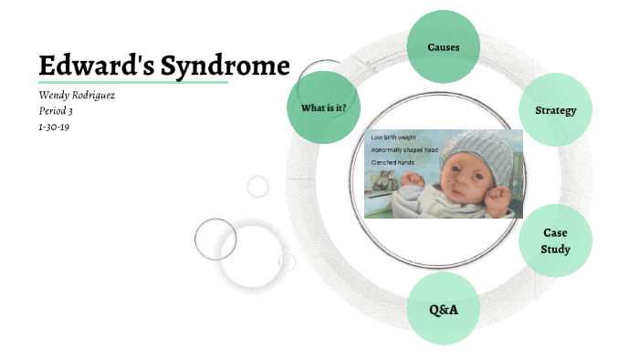 Edward's syndrome by WENDY RODRIGUEZ PEREZ on Prezi