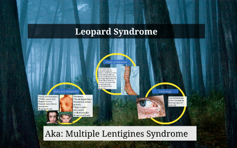 Leopard Syndrome by Ashley Nichols on Prezi