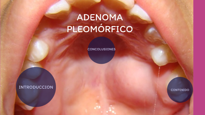 CANCER DE PALADAR by maria de miguel val on Prezi