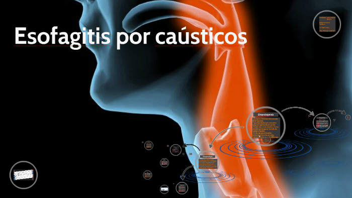 Esofagitis por caústicos by Denise Medina on Prezi