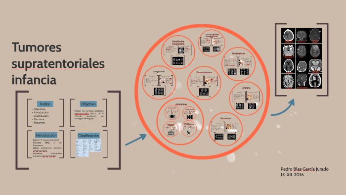 Tumores supratentoriales infancia by Pedro Blas García Jurado on Prezi