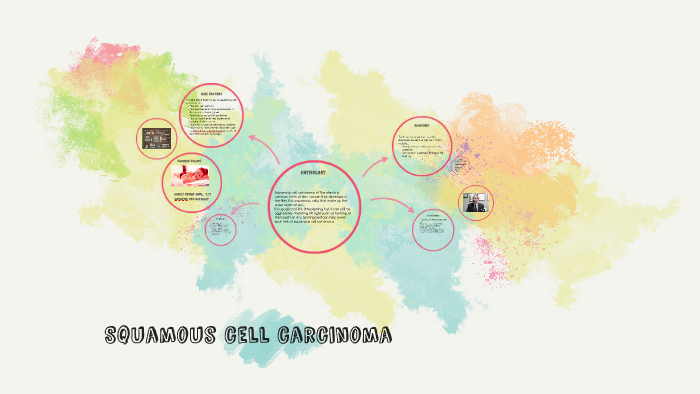 Squamous cell carcinoma by Lauren Keech on Prezi