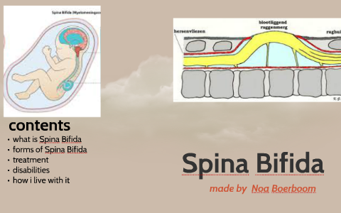 Spina Bifida Occulta by Noa Boerboom on Prezi