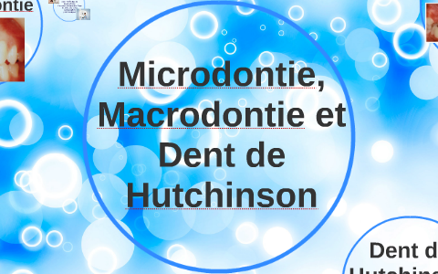 Microdontie, Macrodontie et Dent de Hutchinson by Kristine Lapalme on Prezi