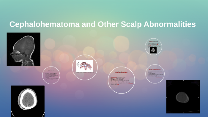 Cephalhematoma and Other Scalp Abnormalities by Scott Wallace on Prezi