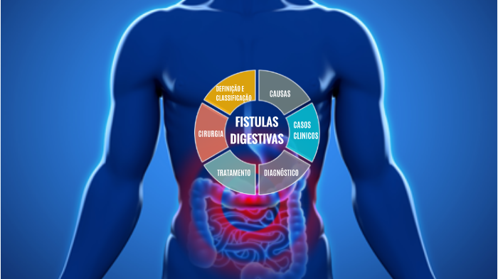 Fistulas Digestivas by Ramon Bezerra on Prezi