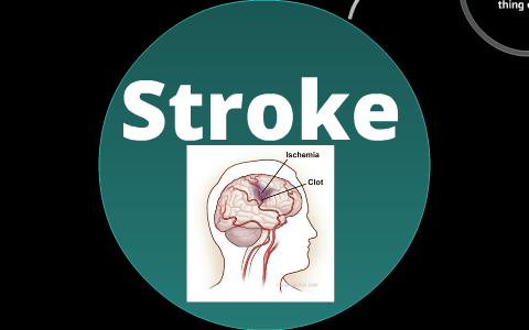 Stroke by bardledoo fdfds on Prezi