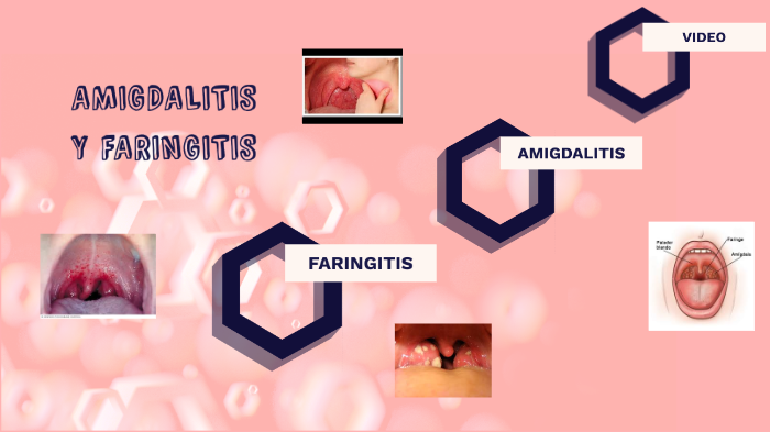 AMIGDALITIS Y FARINGITIS by Lucia Morillas on Prezi