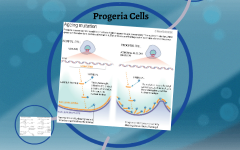 Progeria by Jacob Rood on Prezi