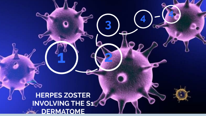 HERPES ZOSTER INVOLVING THE S1 DERMATOME by Karen Pereira on Prezi