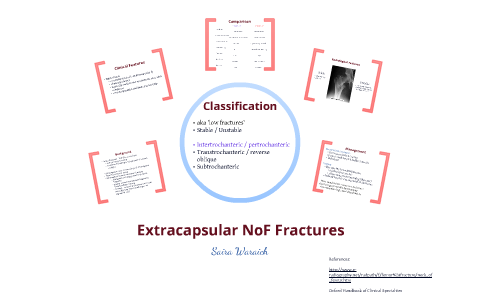 Extracapsular NoF Fractures by Saira Waraich on Prezi