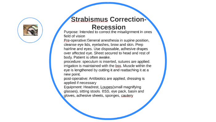 Strabismus Correction-Recession by Kevin Chavis on Prezi