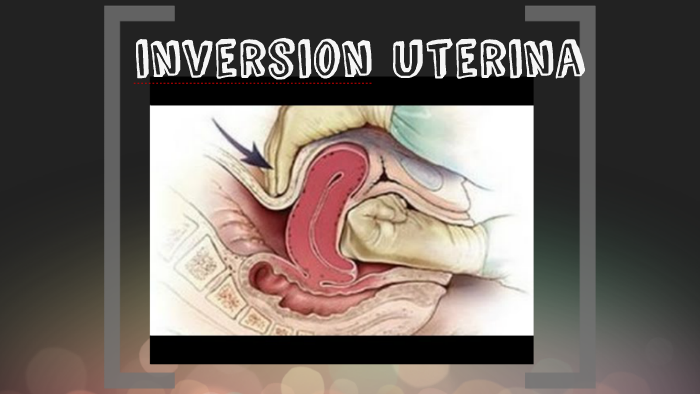 inversion uterina by Jorge Tovar on Prezi