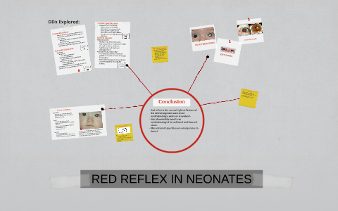RED REFLEX IN NEONATE by Erin Sieck on Prezi