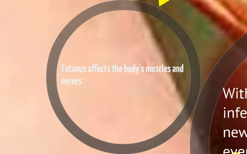 Tetanus Vaccine by Kaseem Jackson on Prezi